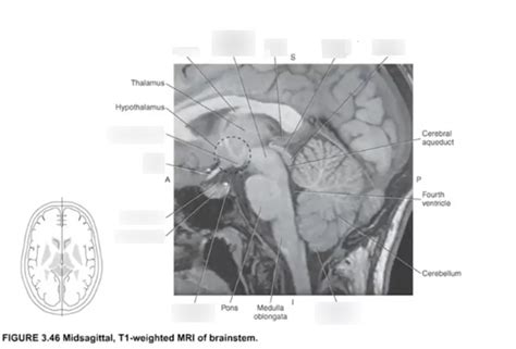 Brainstem Mri Sagittal Diagram Quizlet