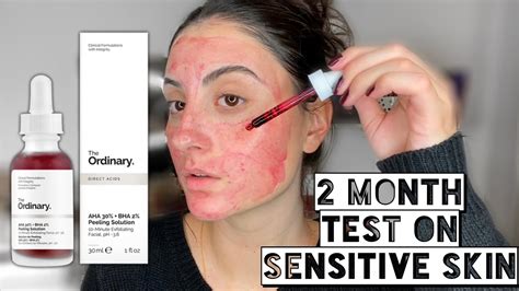 THE ORDINARY AHA 30 BHA 2 PEELING SOLUTION ON ACNE PRONE SENSITIVE