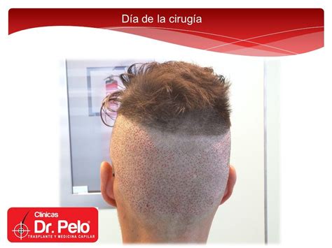 Injerto Capilar Capilar Para Aumento Densidad Enla Zona Frontal Con