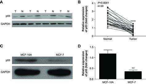 P Expression In Human Breast Cancer Tissue Breast Normal Tissue