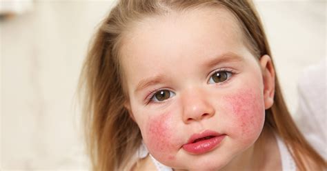 Atopowe zapalenie skóry u dzieci diagnoza i kosmetyki Jak leczyć AZS