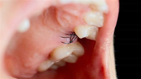 How Long Does It Take Gums To Heal After A Tooth Extraction