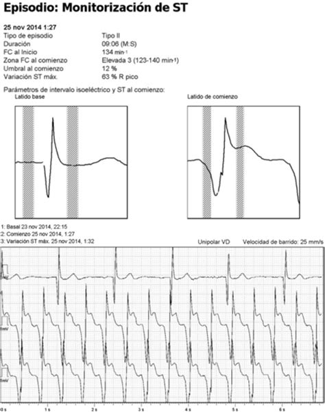 Diagn Stico De Taquicardia Ventricular Por Monitorizaci N Remota