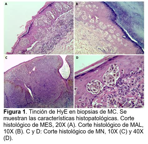 Concordancia entre el diagnóstico clínico e histopatológico de melanoma