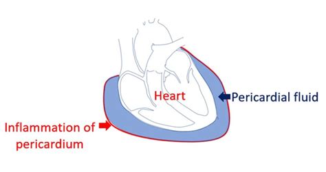 What Is Pericardial Effusion All About Heart And Blood Vessels