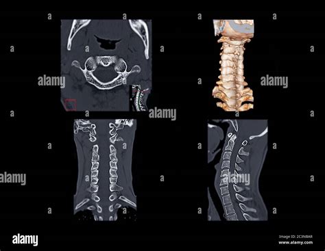 Compare Of CT C Spine Or Cervical Spine Axial View 3D Rendering Image