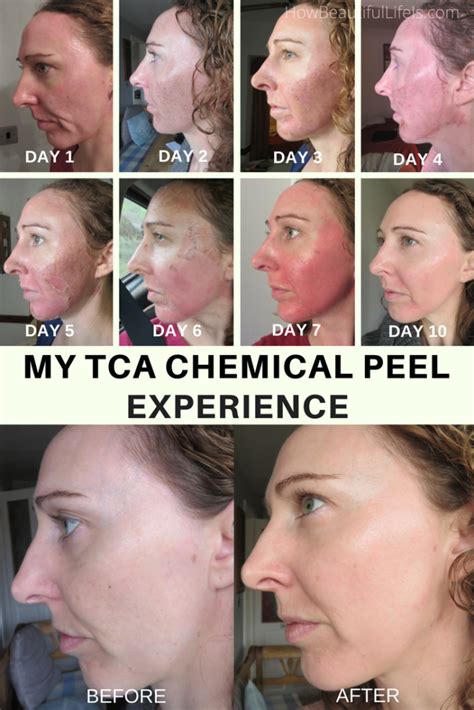 Mild Chemical Peel Before After