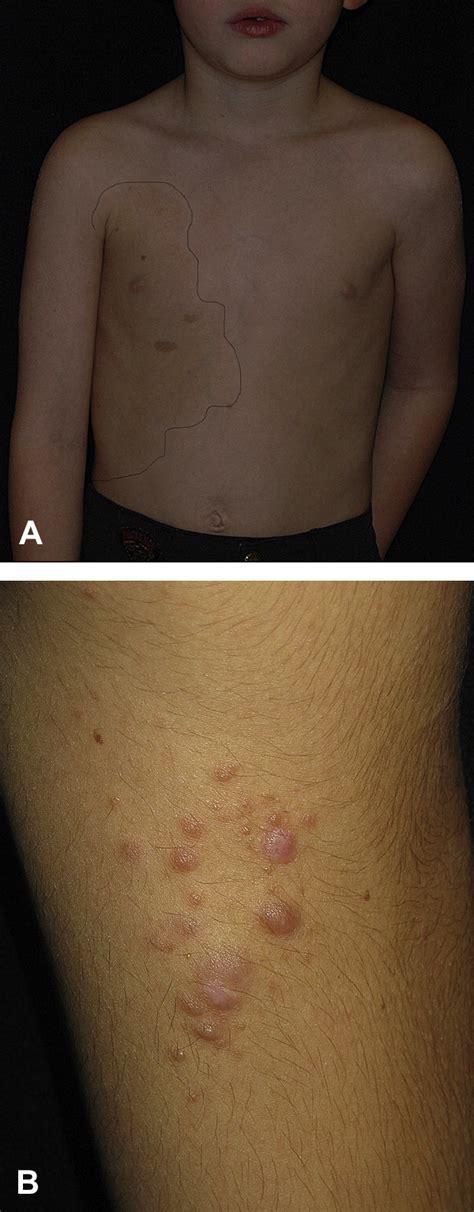 Neurofibromatosis Type 1 Journal Of The American Academy Of Dermatology