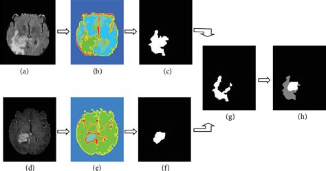 figure 3 from multimodal brain tumor segmentation based on dirichlet process mixture model with