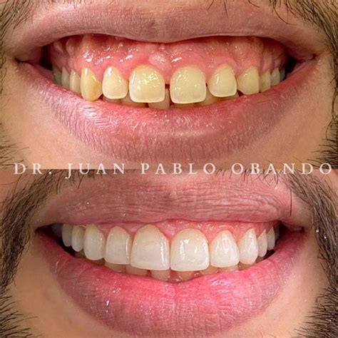 Diseño de Sonrisas Clinica de Estética Dental en Santiago