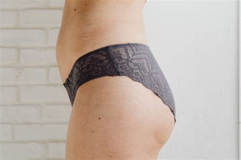 Smagliature Cosa Sono E Come Eliminarle