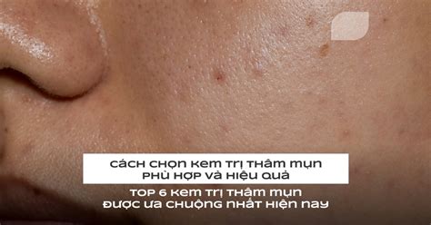Cách chọn kem trị thâm mụn phù hợp và hiệu quả Top 6 được ưa chuộng