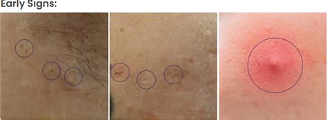 Is Pimple Under Armpit A Symptom Of Hidradenitis Suppurativa Treat