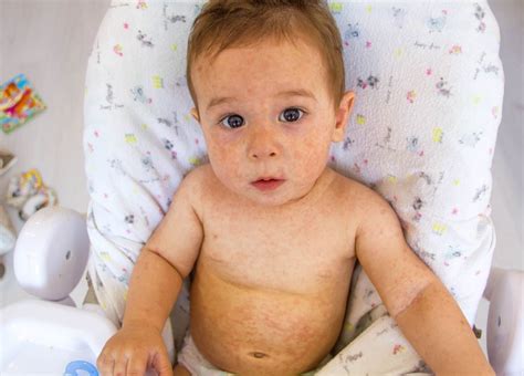 Alergia Pokarmowa U Dzieci Objawy Zdjęcia Polska Zdjecia