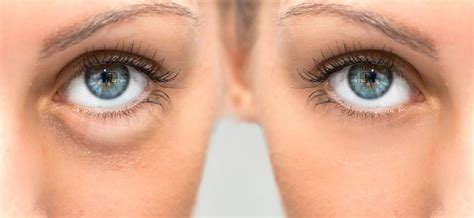 Poches Sous Les Yeux Traitement Sans Chirurgie CSHP