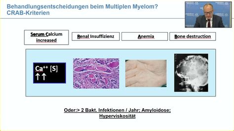 Prof Einsele Neue Therapiemoeglichkeiten Beim Multiplen Myelom YouTube
