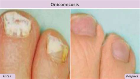 Cl Nica L Ser De Piel Onicomicosis Hongos En Las U As Cl Nica L Ser