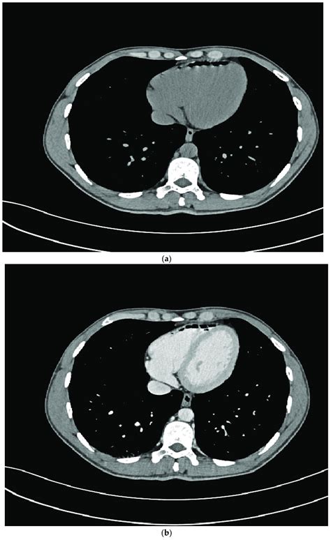 A Pre Hbo Chest Ct Scan W O Contrast Medium And B With Contrast