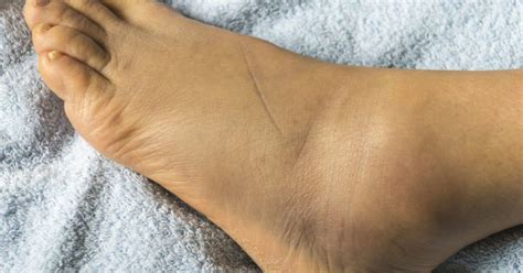 Itchy Ankles Causes Rash And Treatment Artofit