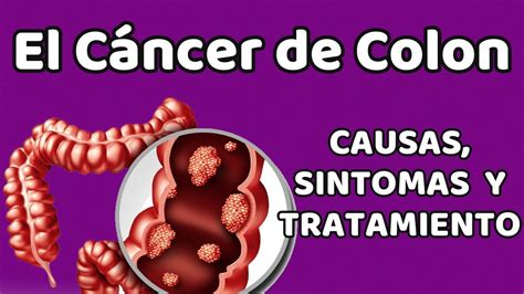 EL CÁNCER DE COLON Causas signos y síntomas diagnóstico y