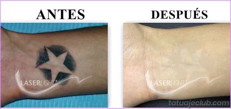 Es peligroso quitar un tatuaje láser peligros y efectos secundarios de