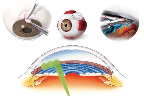 What Is Selective Laser Trabeculoplasty SLT Surgery OBN