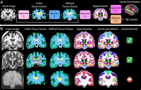 robust machine learning segmentation for large scale analysis of heterogeneous clinical brain