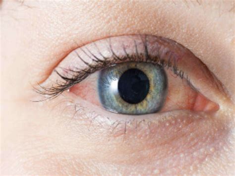 Conjunctivitis Conjunctivitis Symptoms