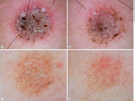 Figure 3 From Studying Regression Of Seborrheic Keratosis In Lichenoid