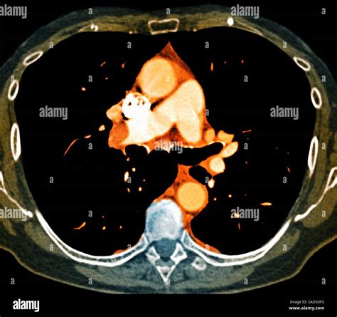 Embolia Polmonare Colorato La Tomografia Computerizzata Ct Scansione