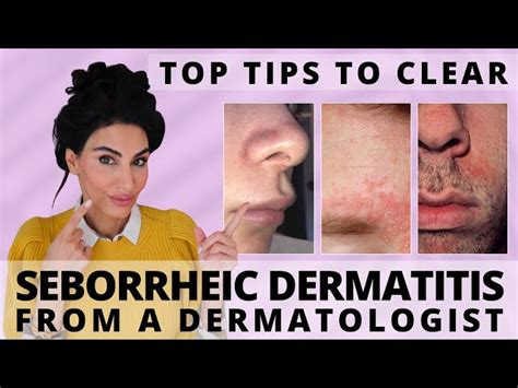Seborrheic Dermatitis Face Women