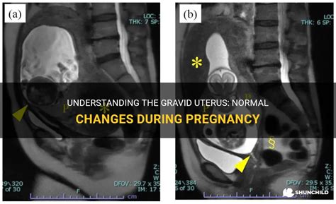 Understanding The Gravid Uterus Normal Changes During Pregnancy