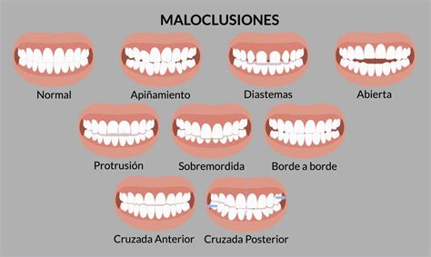 Maloclusión qué es y cómo se soluciona con ortodoncia invisible