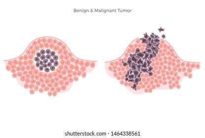 Tumor Benigno Vs Maligno