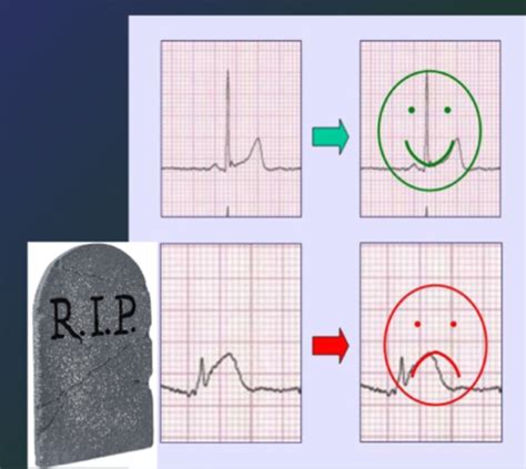 Acute Coronary Syndromes Flashcards Quizlet