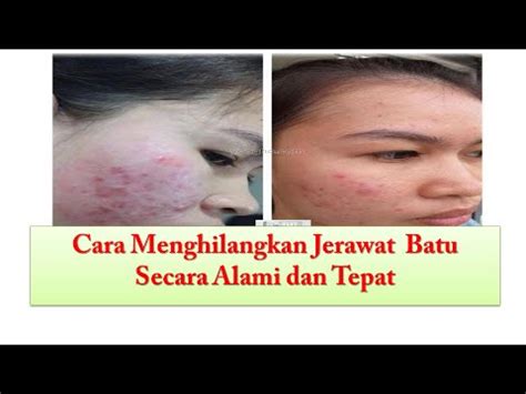 Cara Menghilangkan Jerawat Batu Secara Alami Dan Tepat Youtube