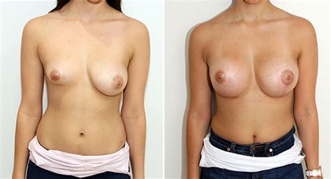 Breast Asymmetry Dr Michael Miroshnik