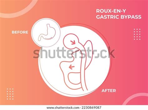 Roux En Y Gastric Bypass Rny Over 16 Royalty Free Licensable Stock