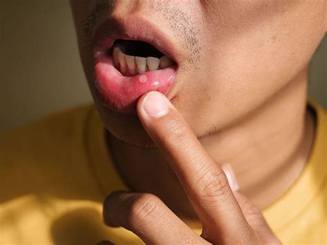 Painless Ulcers Floor Of Mouth Home Alqu