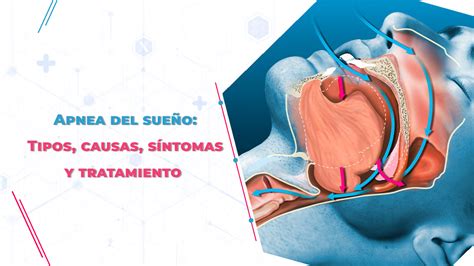 Apnea del Sueño Tipos Causas Síntomas y Tratamiento