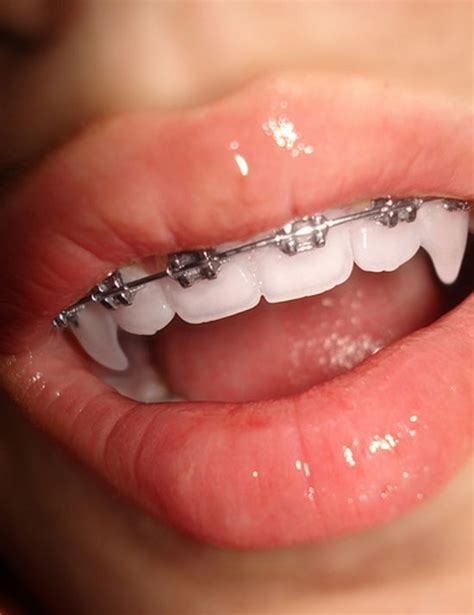 Random Radness Vol 73 Vampire Teeth Teeth Aesthetic Lip Art
