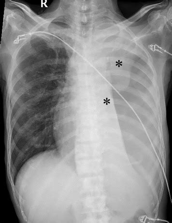 A Man With Shortness Of Breath After Thoracocentesis Annals Of
