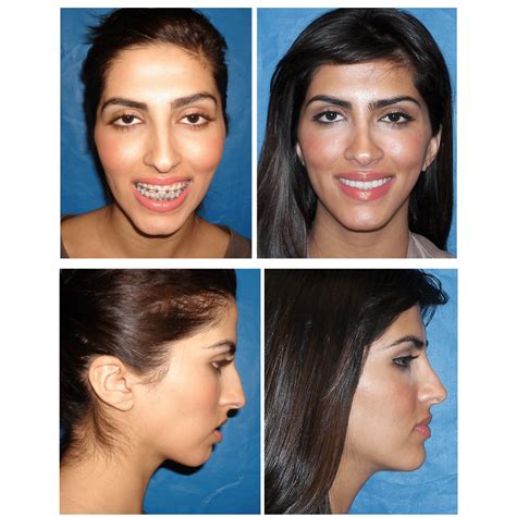 Before After Surgery Photos Dr Larry M Wolford DMD