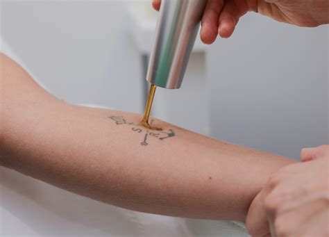 D Tatouage Laser Picoseconde Cannes Centre Esth Tique Cannes