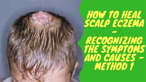 How To Heal Scalp Eczema Recognizing The Symptoms And Causes Method 1 Youtube