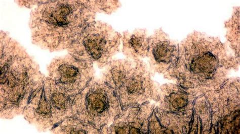Health Department Tuberculosis Cases Rise In SLO County CA San Luis
