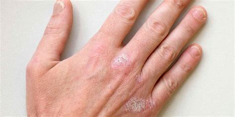 ARTRITE PSORIÁSICA Portal da Reumatologia