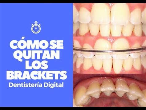 CÓMO SE QUITAN LOS BRACKETS Todo lo que debes saber YouTube