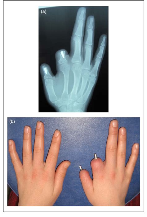 Figure From Esthetic Functional And Prosthetic Outcomes With