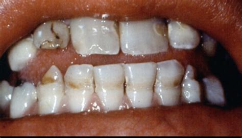 Abnormalities Of Teeth Flashcards Quizlet